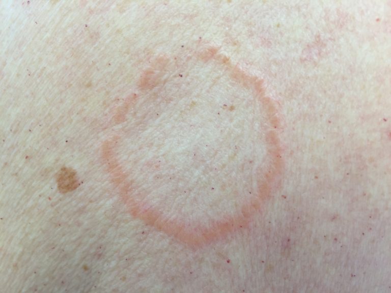 Granuloma Annulare - Appalachian Spring Dermatology