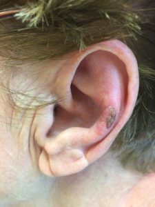 What's this sore on my ear? | Appalachian Spring Dermatology
