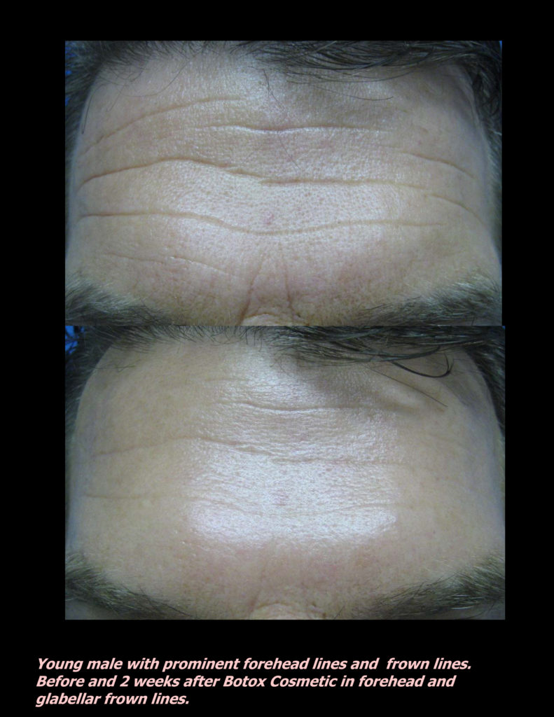 Botox, Xeomin & Jeuveau - Appalachian Spring Dermatology