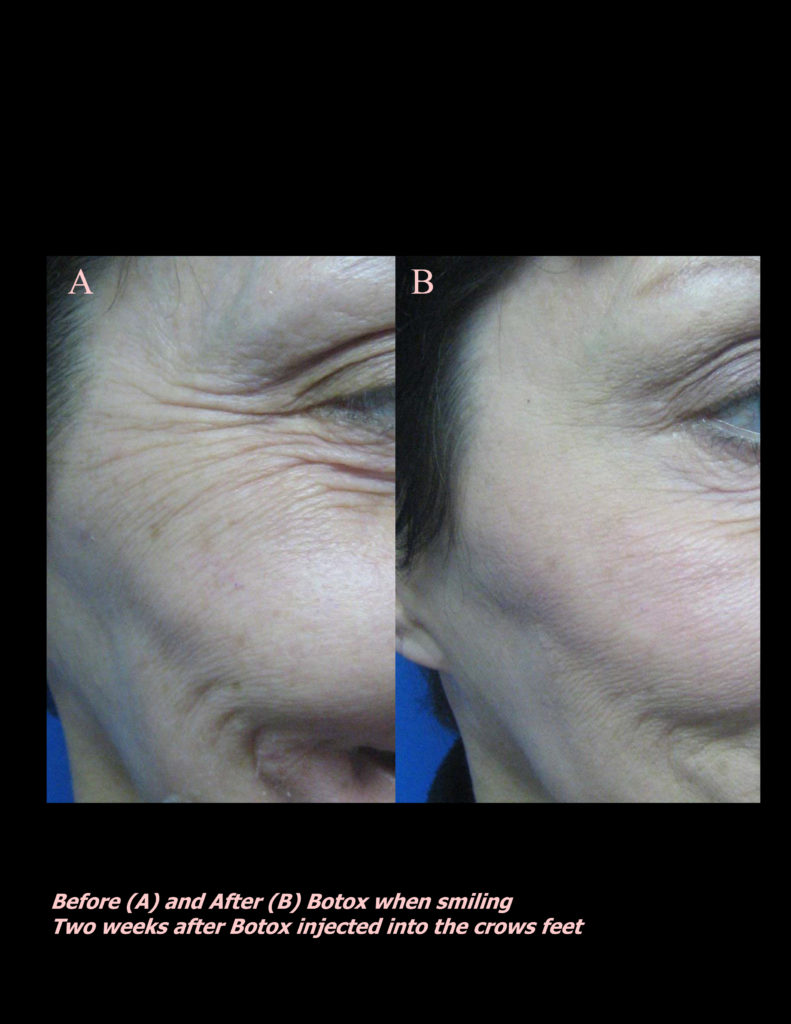 Botox, Xeomin & Jeuveau - Appalachian Spring Dermatology