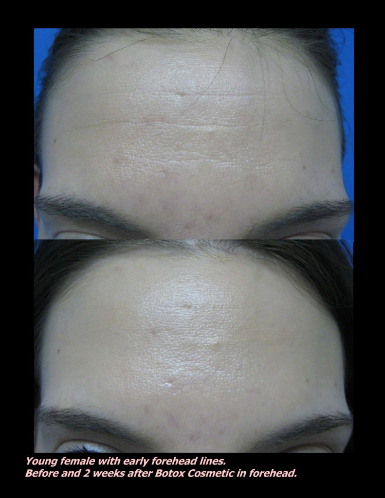 Botox, Xeomin & Jeuveau - Appalachian Spring Dermatology