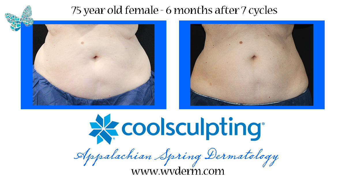 What are these purple spots on my arms? Senile Purpura – Appalachian ...